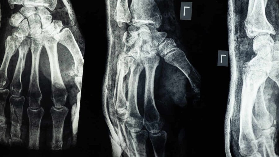 Gymnastics Injuries: Minimizing the Risks & Flipping for Fitness